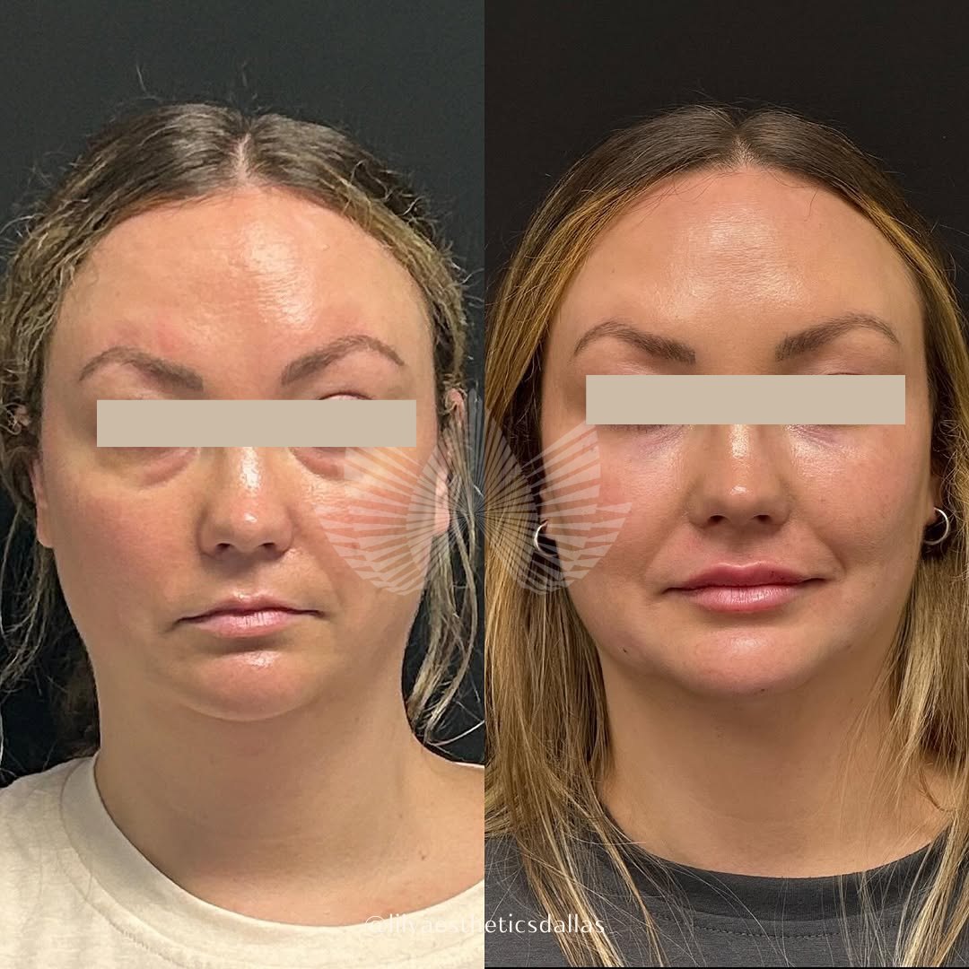 BBL Photorejuvenation Dallas, TX | Lily Aesthetics